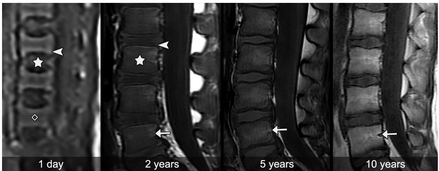 Vertebral body maturation and marrow conversion during early