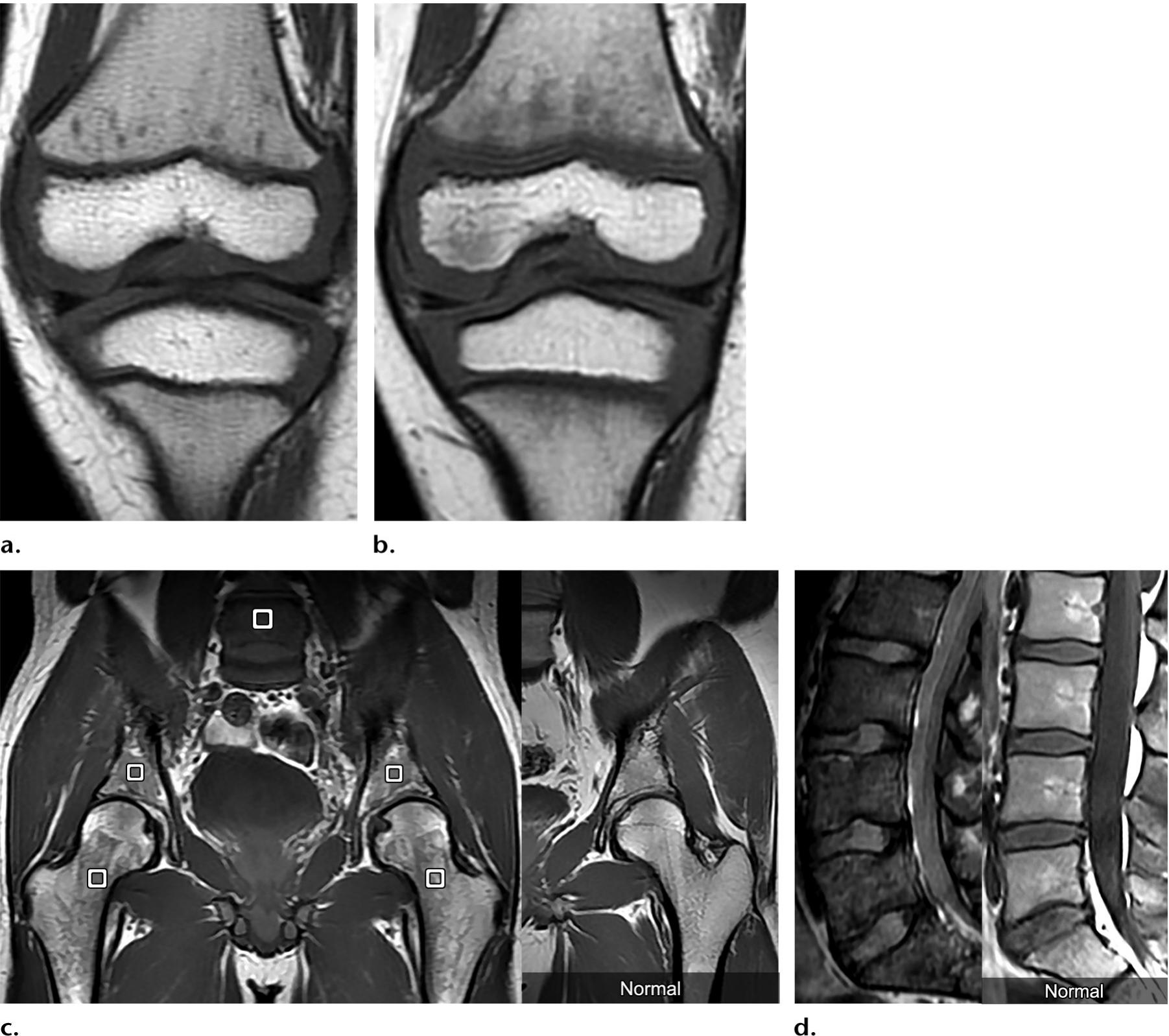 Red marrow hyperplasia. (a, b) a 3-year-old girl with