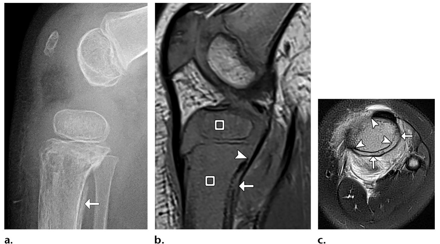 Pathologic fracture due to all in a 2-year-old girl. (a)