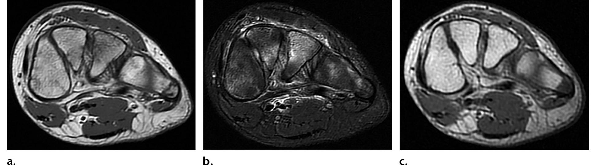 Crps in an 11-year-old girl with persistent pain,