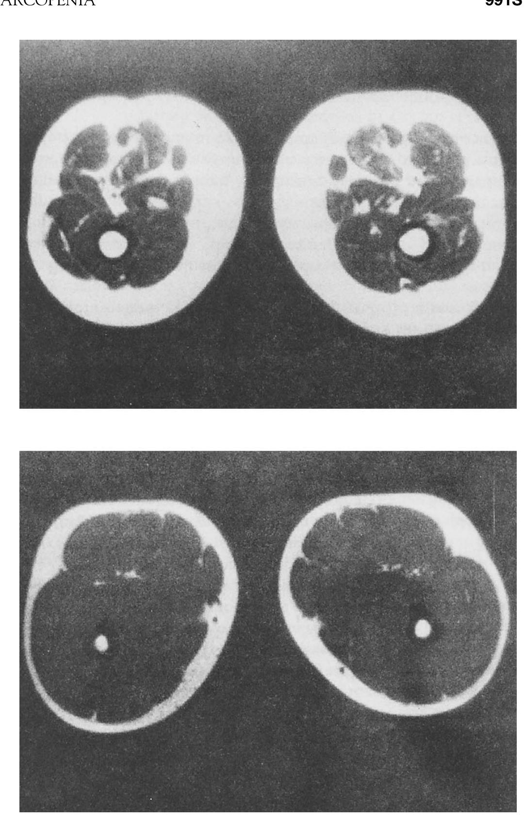 Proportion of lean-body mass vs. fat in the thighs of a