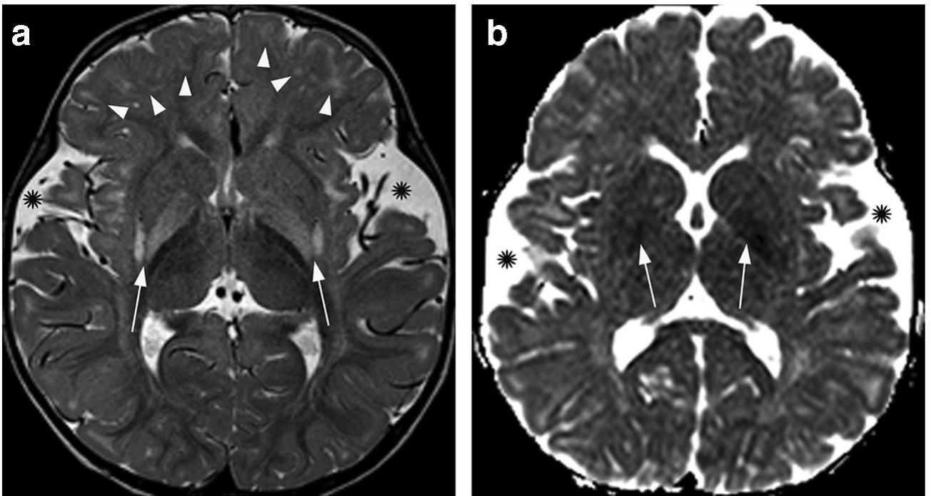 Posterior putamina (arrows). b adc map reveals lower signal