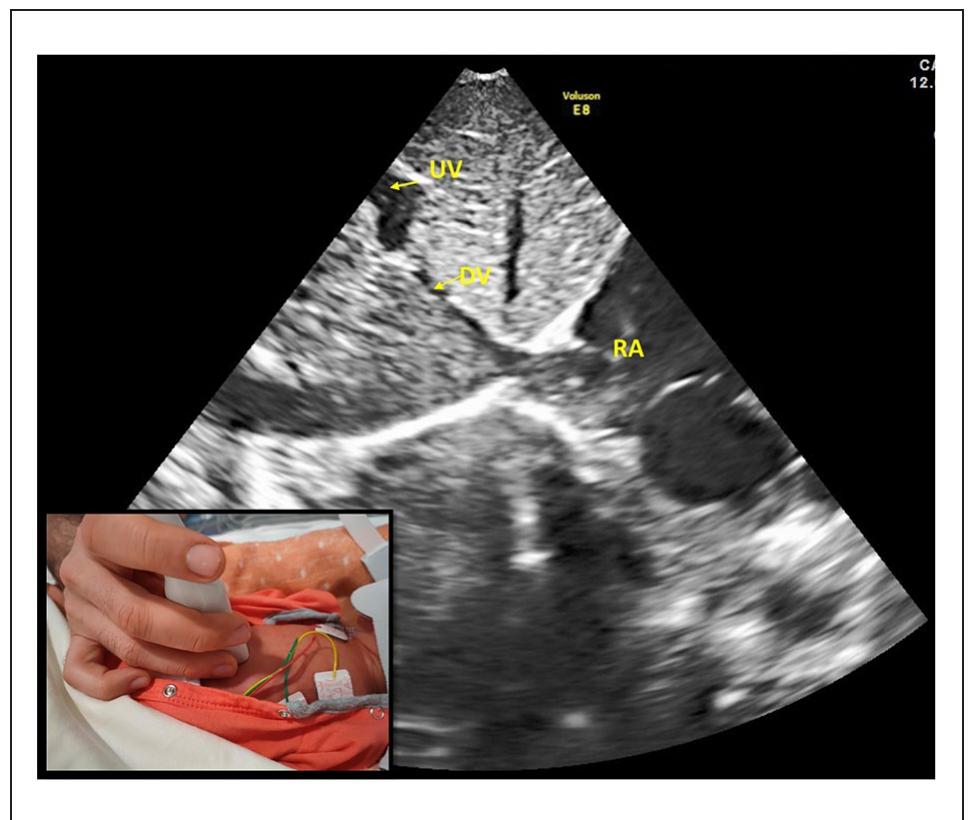 |. subcostal longitudinal view. the pathway of fetal