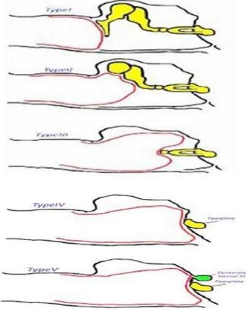 Wullstein classification of tympanoplasty [25] volume 8