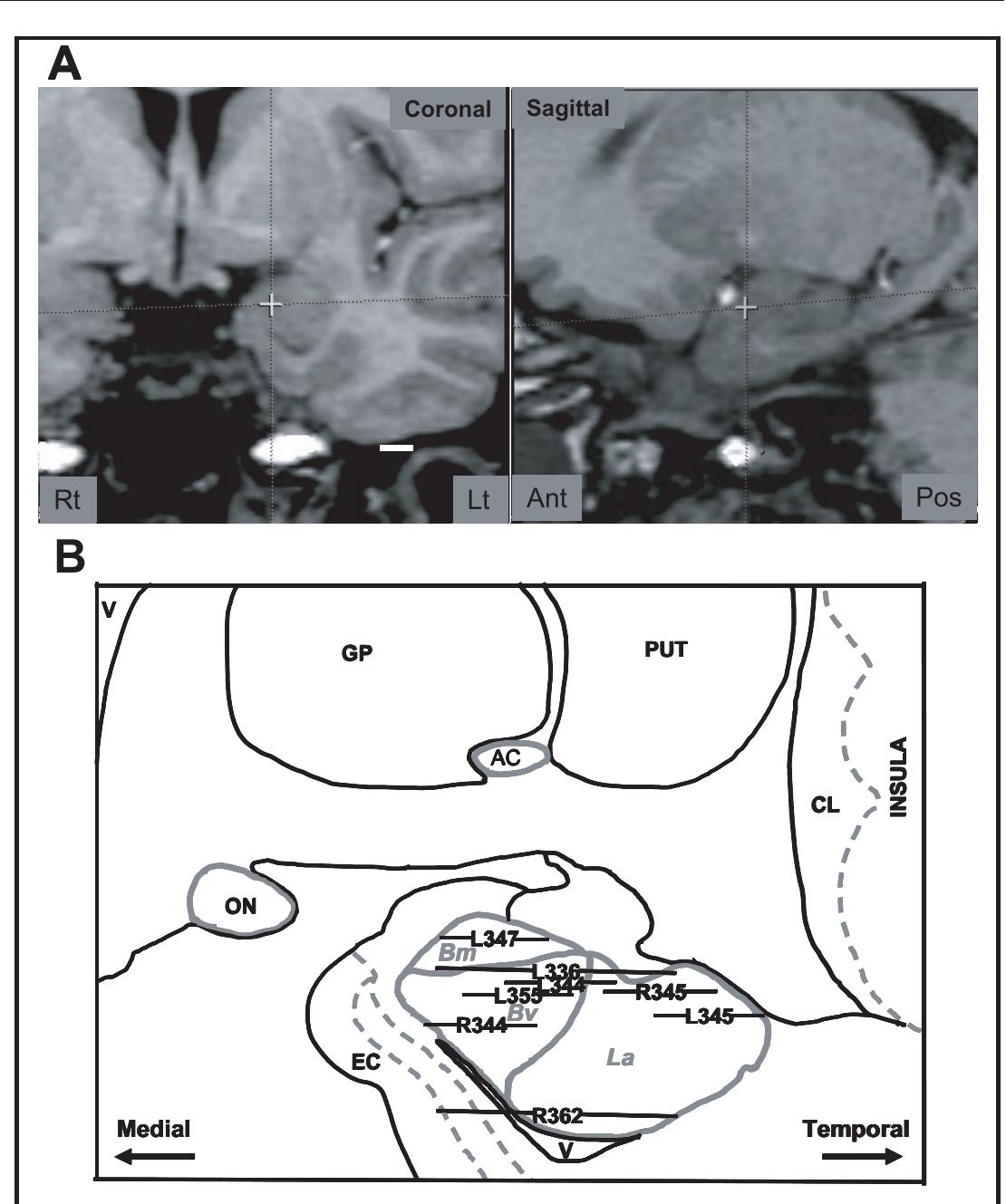 a) magnetic resonance imaging (mri) scan of a hu- man