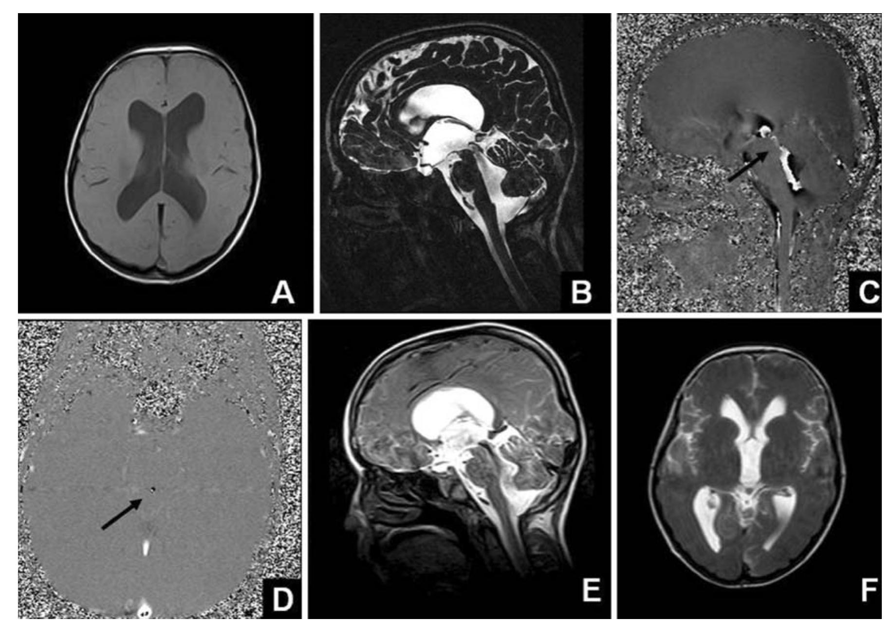 An 11-year-old male patient subjected to mri because of