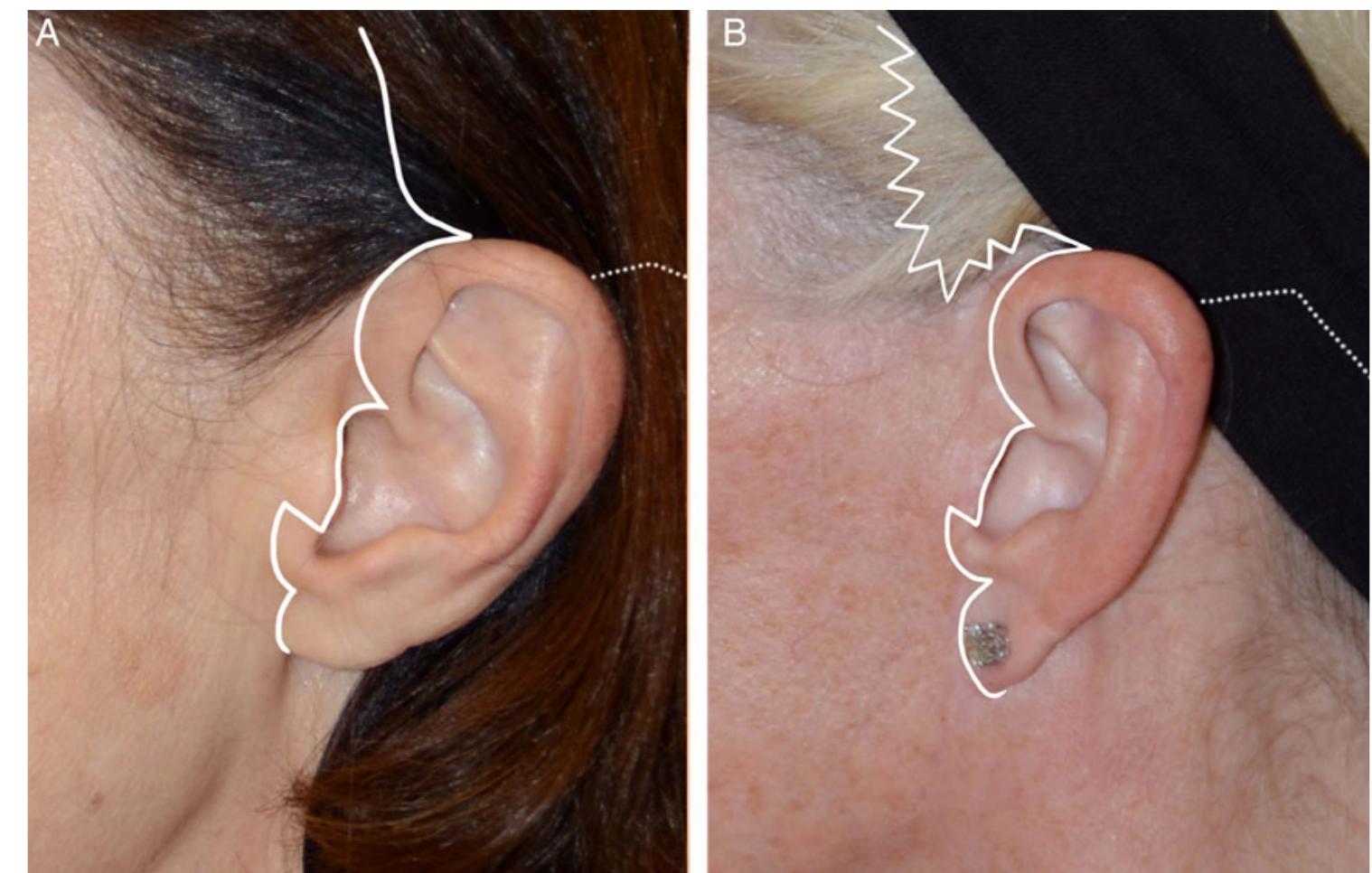 (a) incision diagram for primary total composite flap