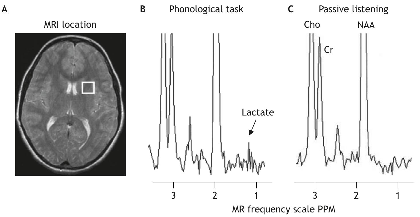 The magnetic resonance spectroscopy findings showed the