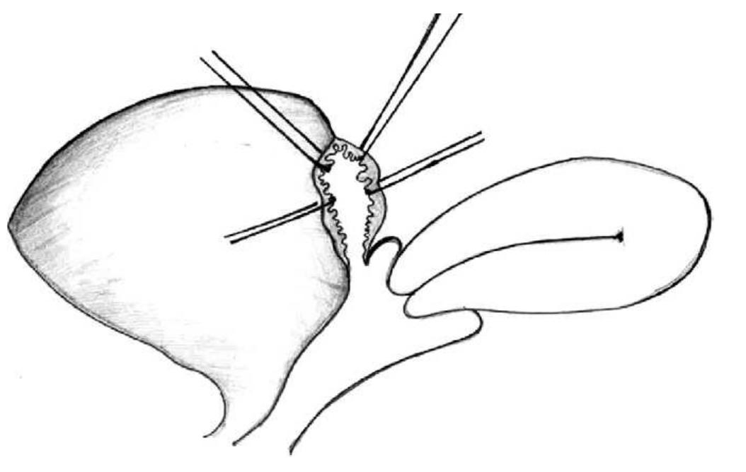- the cystotomy is made only on the posterior bladder wall