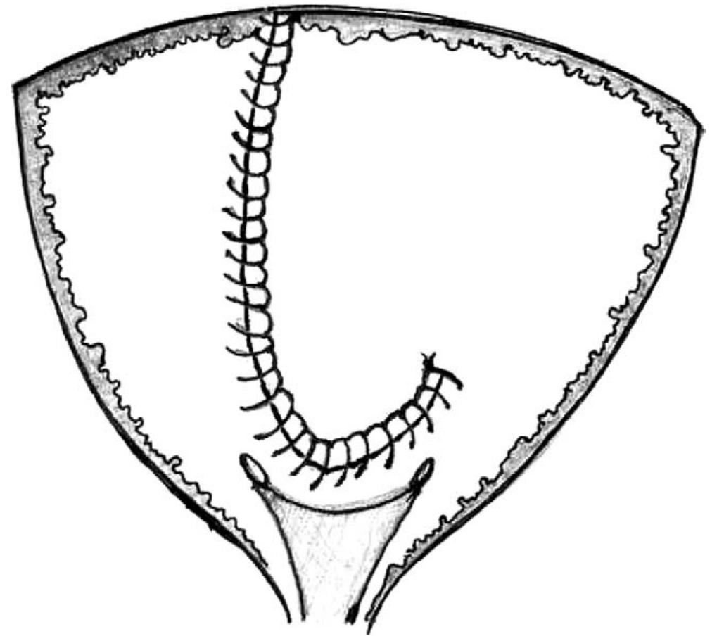 the bladder flap achieves tensionless suture line in the