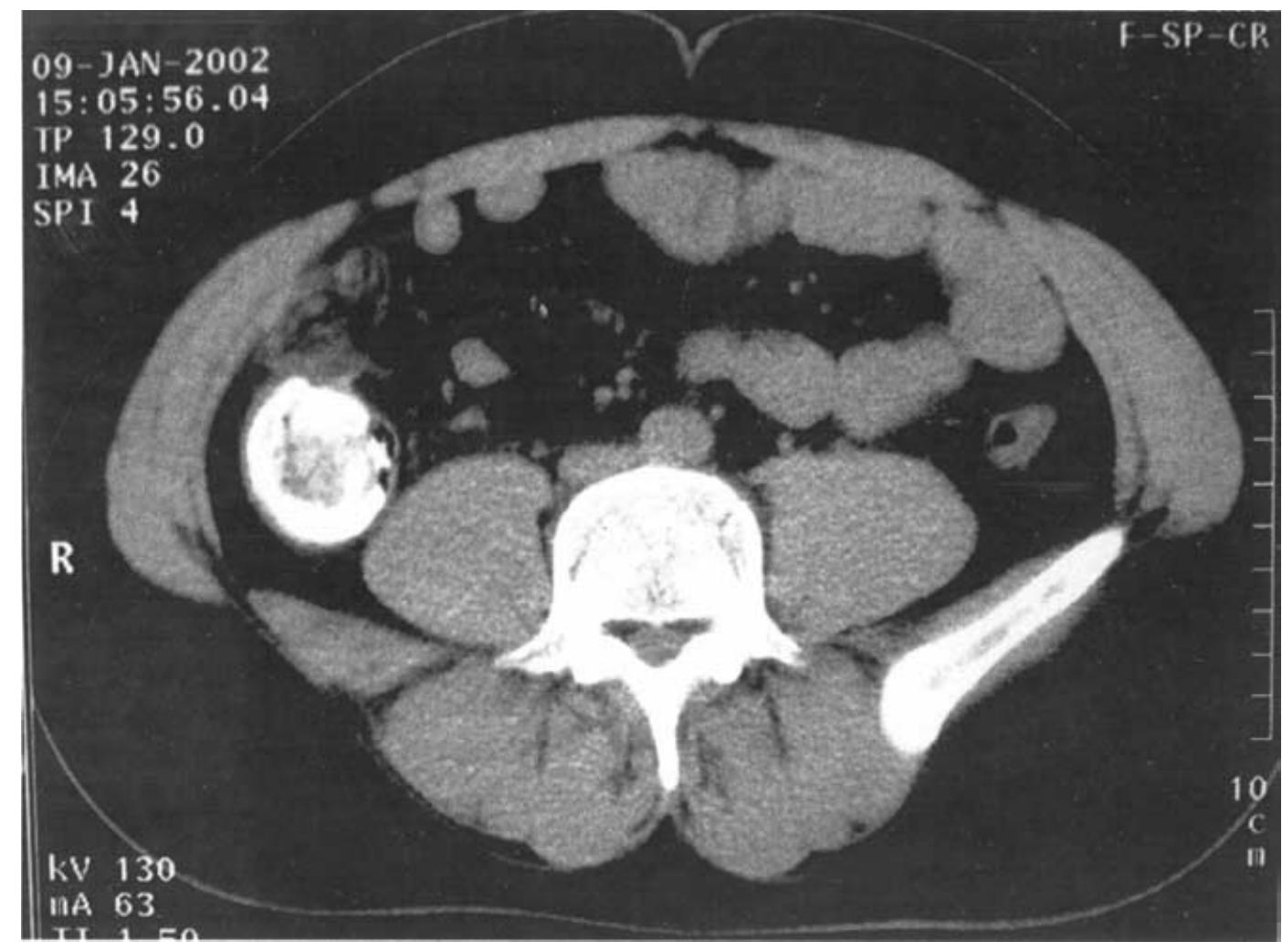 Ct scan abdomen showing a calcified mass in the