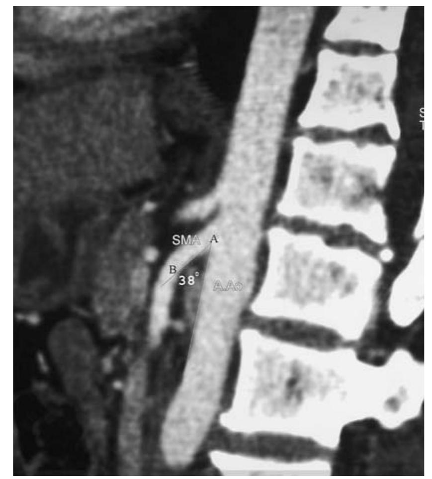 , measurement of the angle between the sma and aorta. a rep-