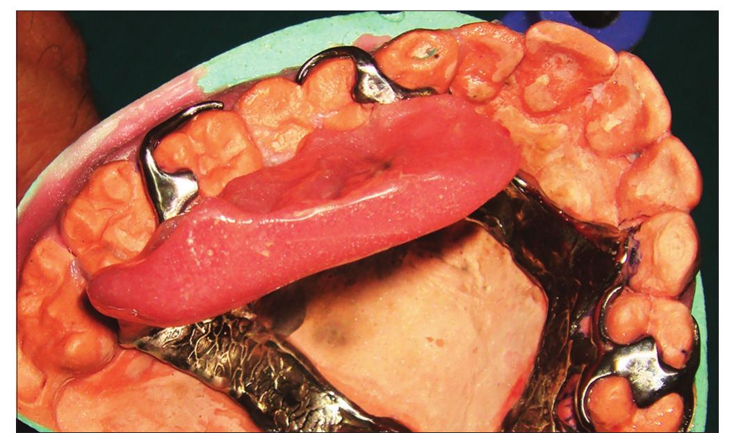 Palatal ramp attached to the maxillary framework