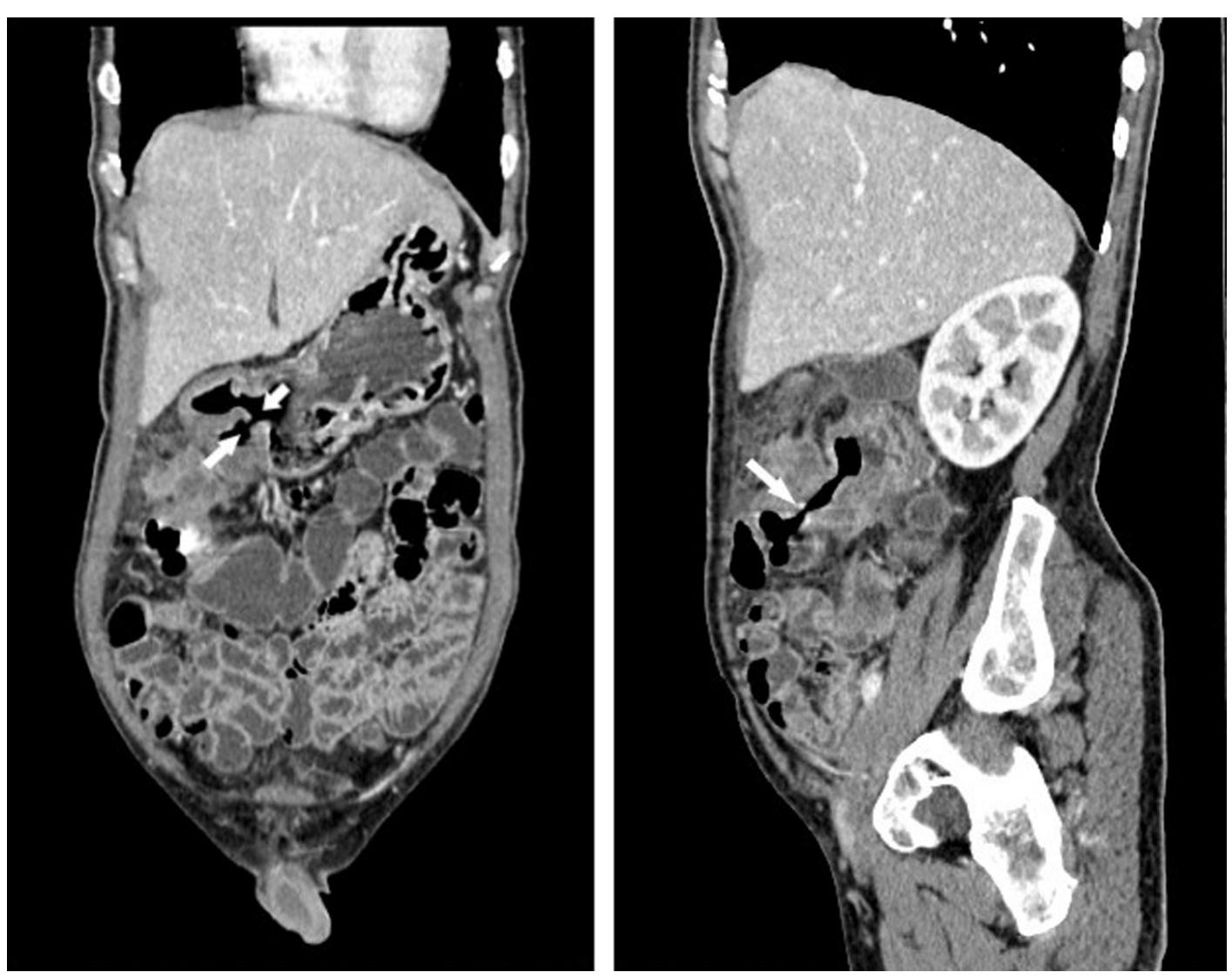 Preoperative sagittal and coronal ct scan revealing