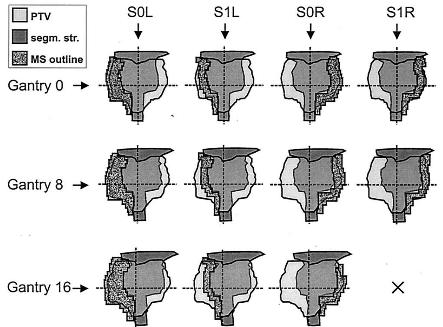 Anatomy-based arc generation shown in beam’s-eye view (bev).