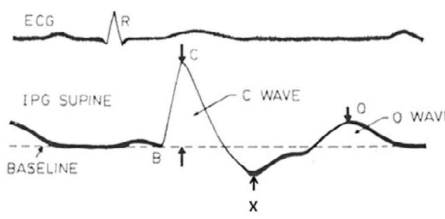 Schematic representation of electrocar- diogram (ecg) and