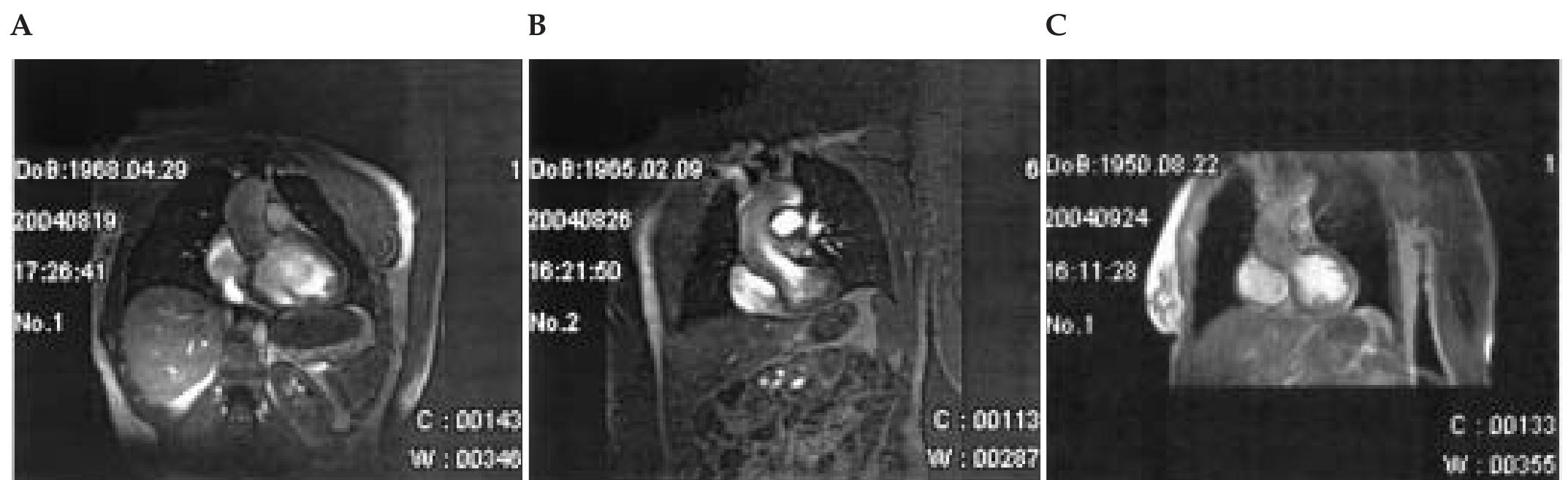 Parasagittal view of chest mri in three patients with aortic