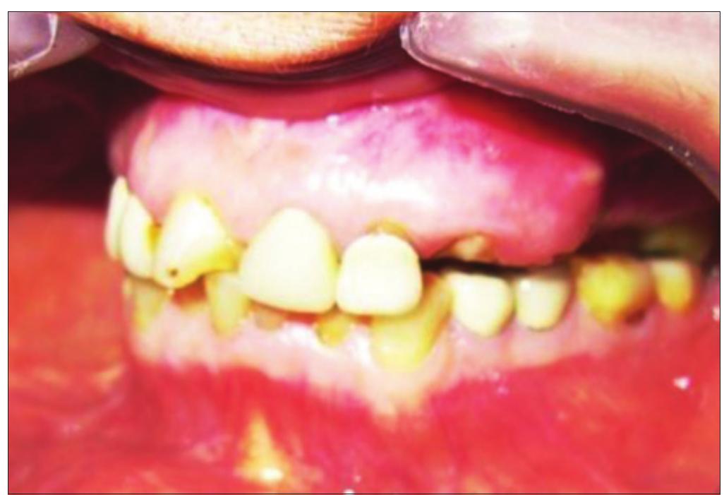Figure 1 - from Modified Dahl Appliance: A Clinical Report
