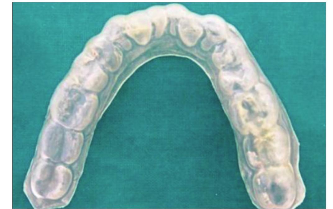 Figure 2 - from Modified Dahl Appliance: A Clinical Report