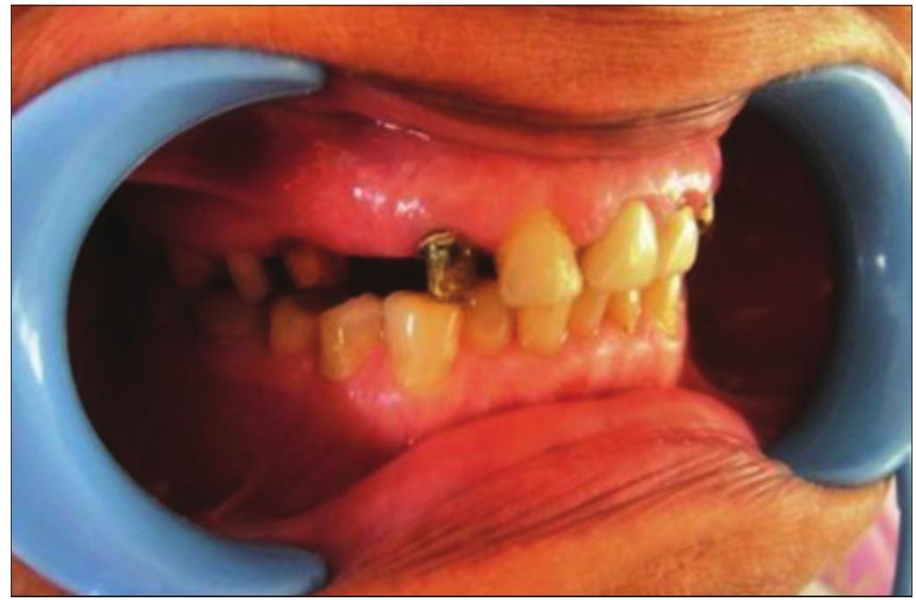 Figure 4 - from Modified Dahl Appliance: A Clinical Report