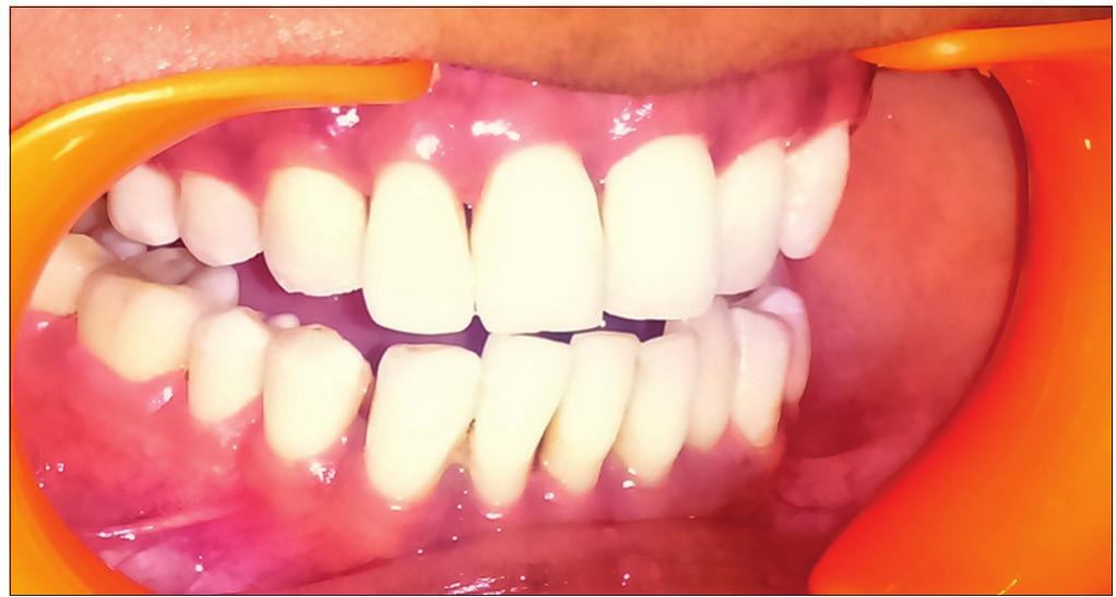 Postoperative: interdental papilla coverage after 3 months