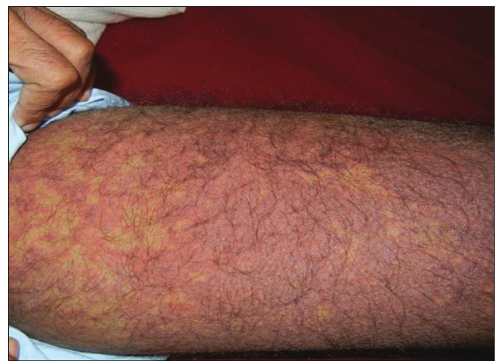 Erythematous maculopapular rash over thigh figure 2: