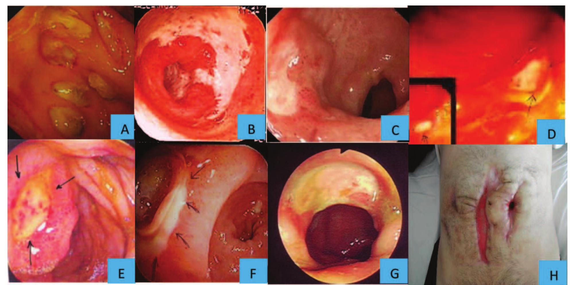 The types of endoscopic ulcers in gastrointestinal behcet’s
