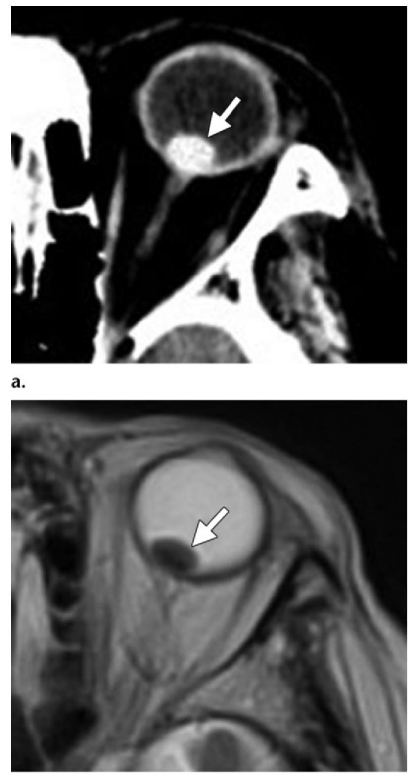 Posterior complete lens dislocation in a 72-year-old man.