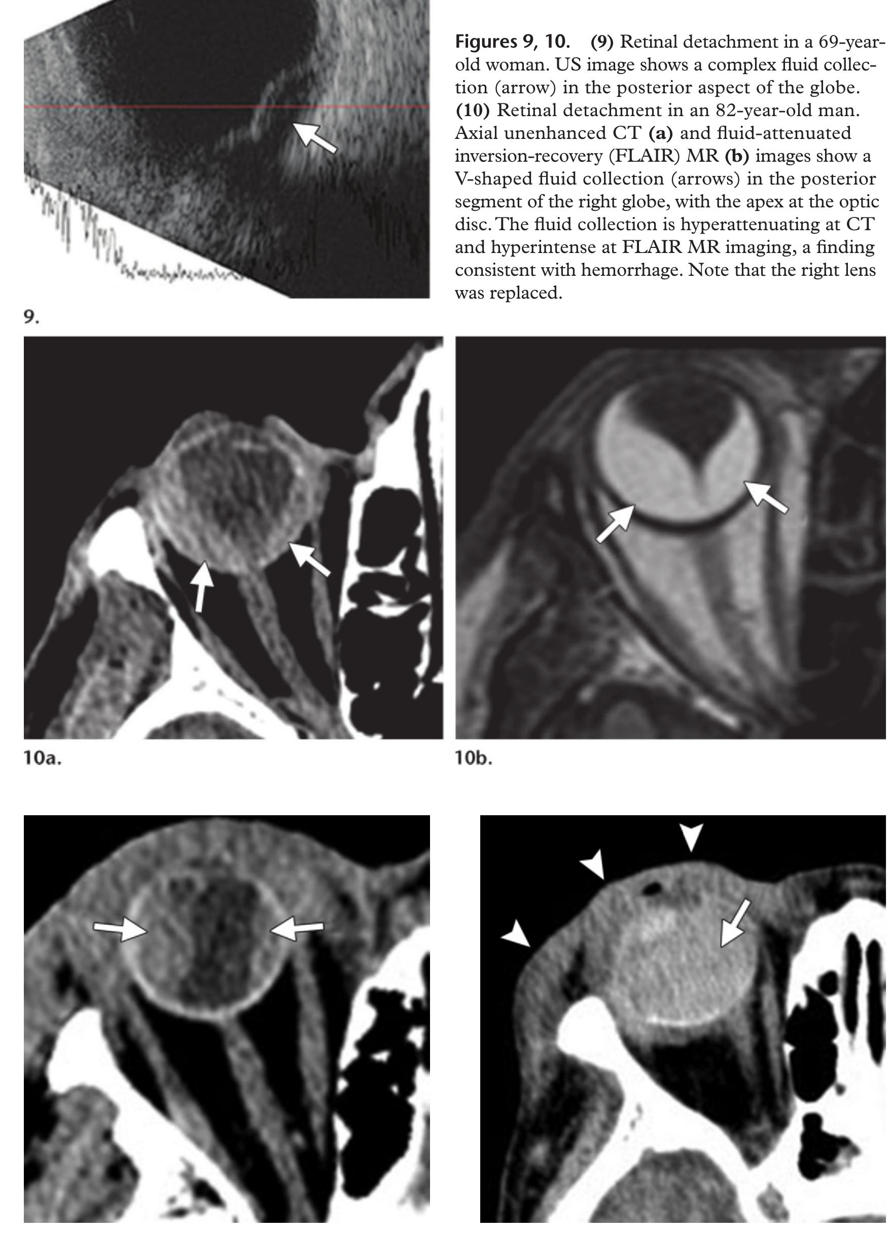 Vitreous hemorrhage in a 92-year- old woman. axial