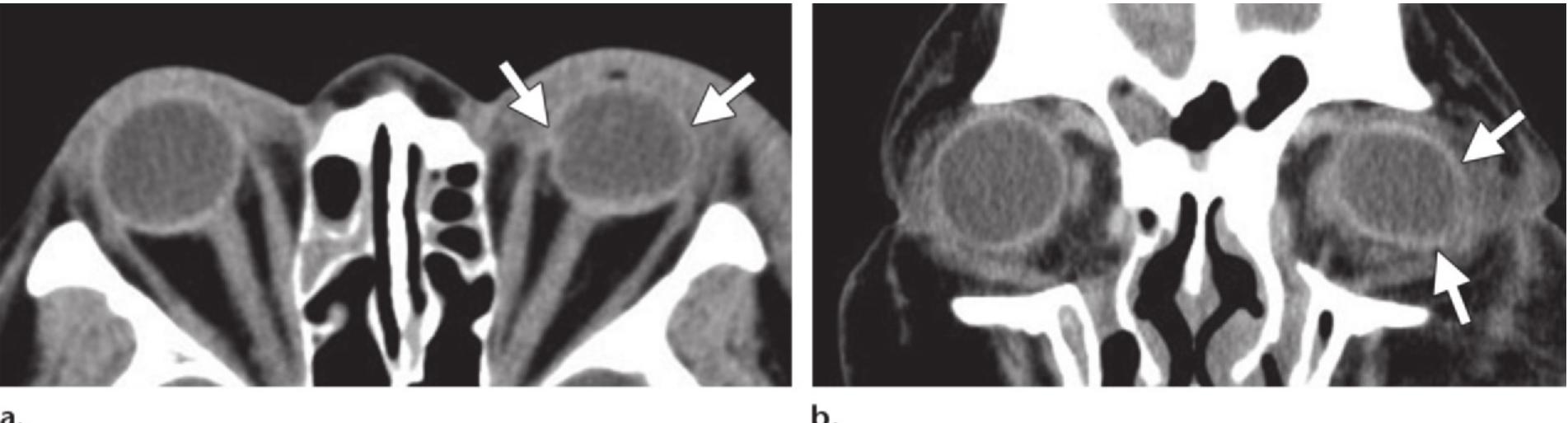 Open-globe injury in a 68-year-old woman. axial (a) and