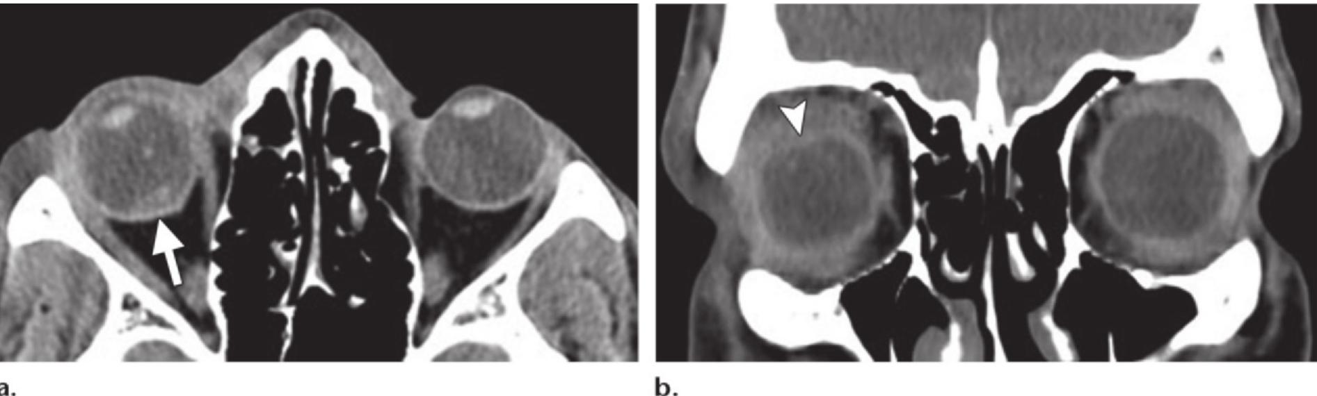 Open-globe injury in a 48-year-old man. (a) axial unenhanced