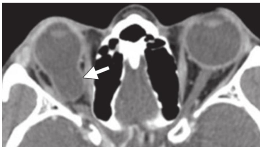 Coloboma in a 35-year-old man. axial unenhanced ct image