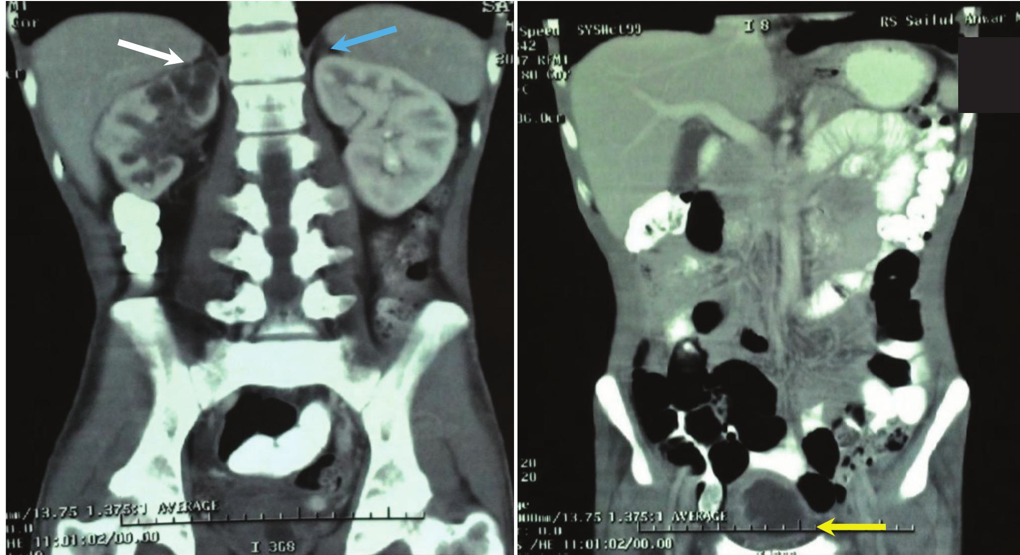 Ct scan of the abdomen on coronal view showed a right
