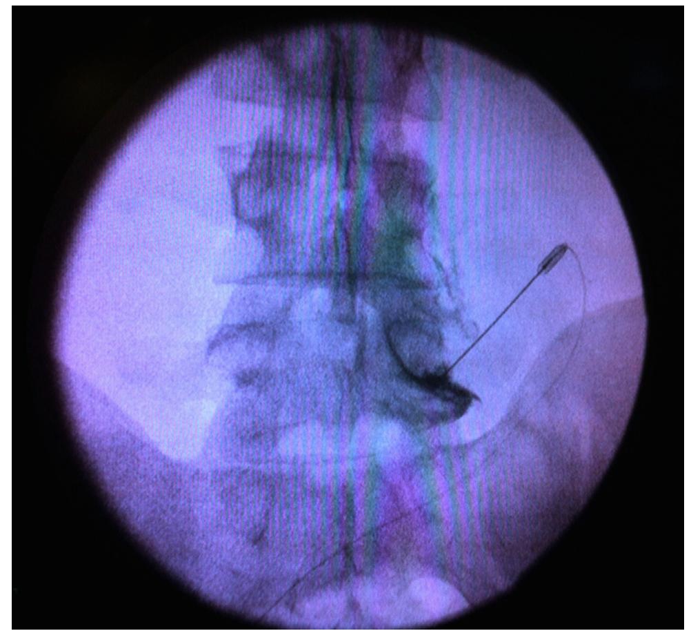 - normal transforaminal epidural contrast agent flow. lumbar