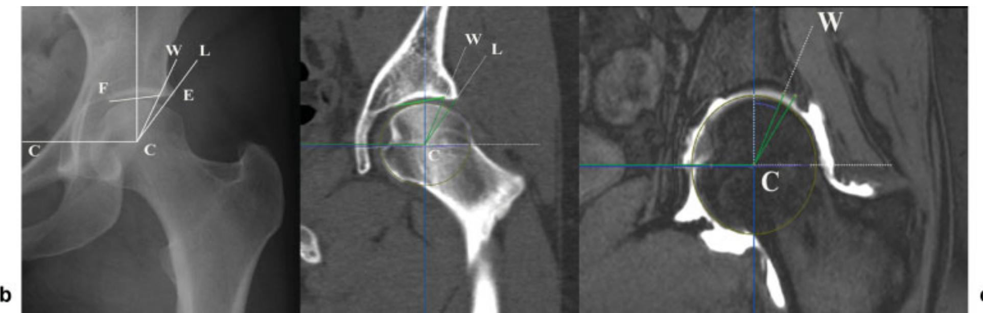 Measurement of acetabular craniocaudal coverage using wiberg