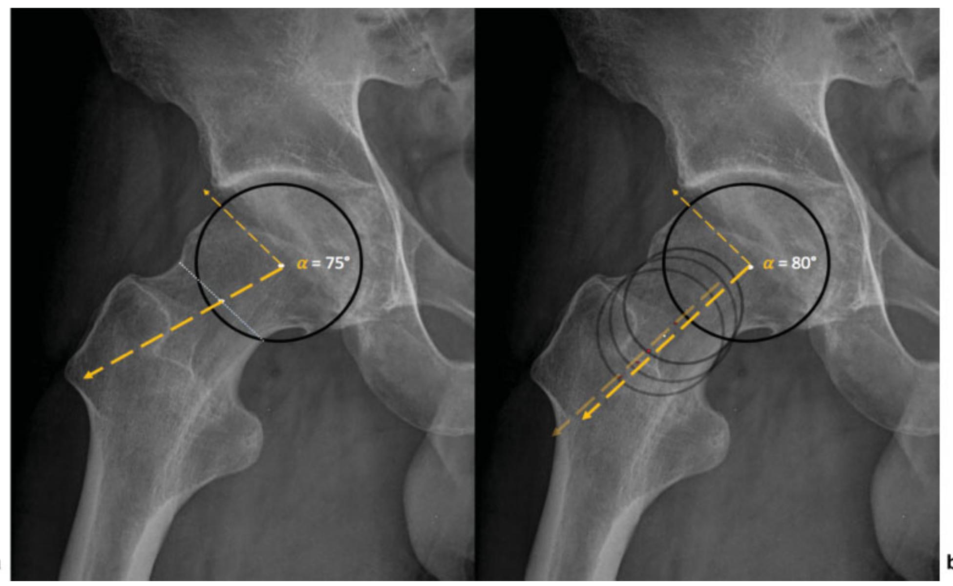 Dunn 45-degree lateral view of the right proximal femur of a