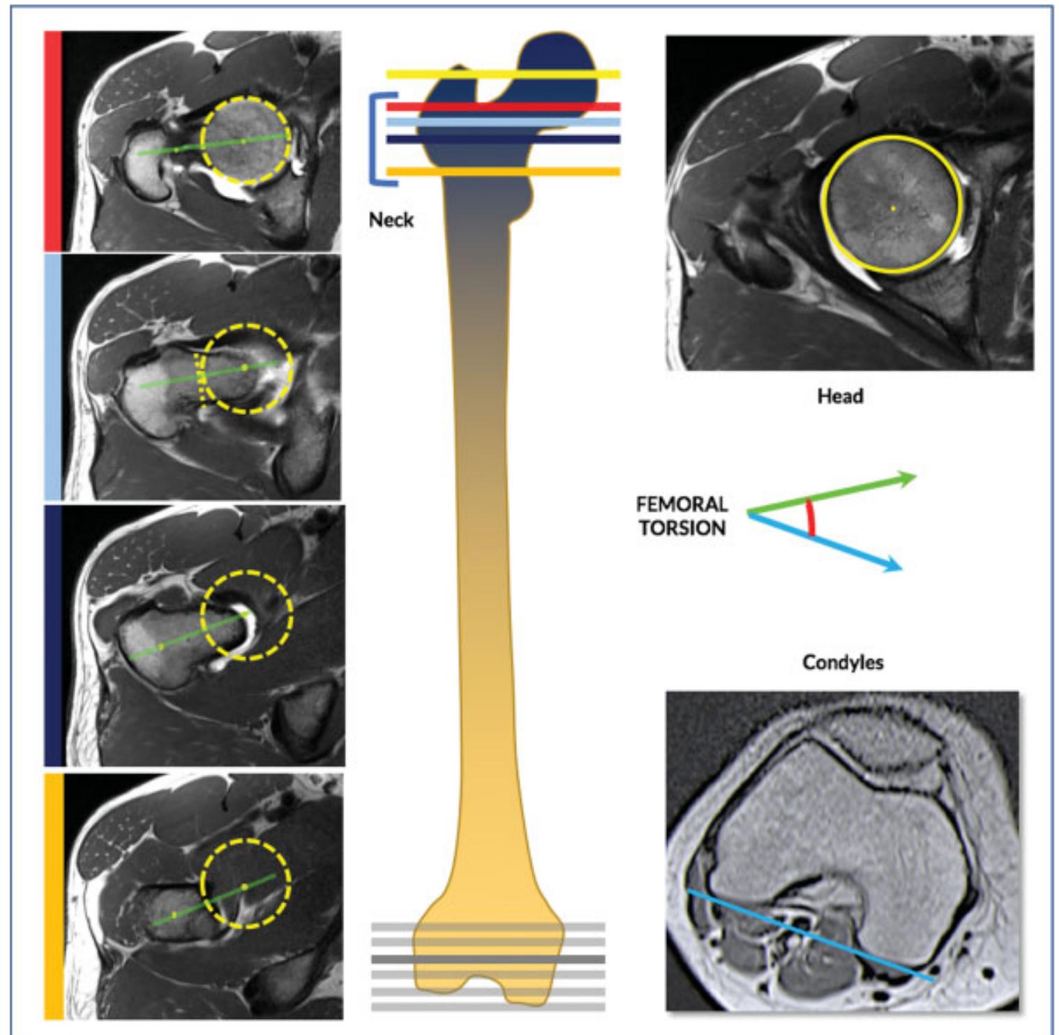 Assessment of femoral torsion on cross-sectional imaging. on