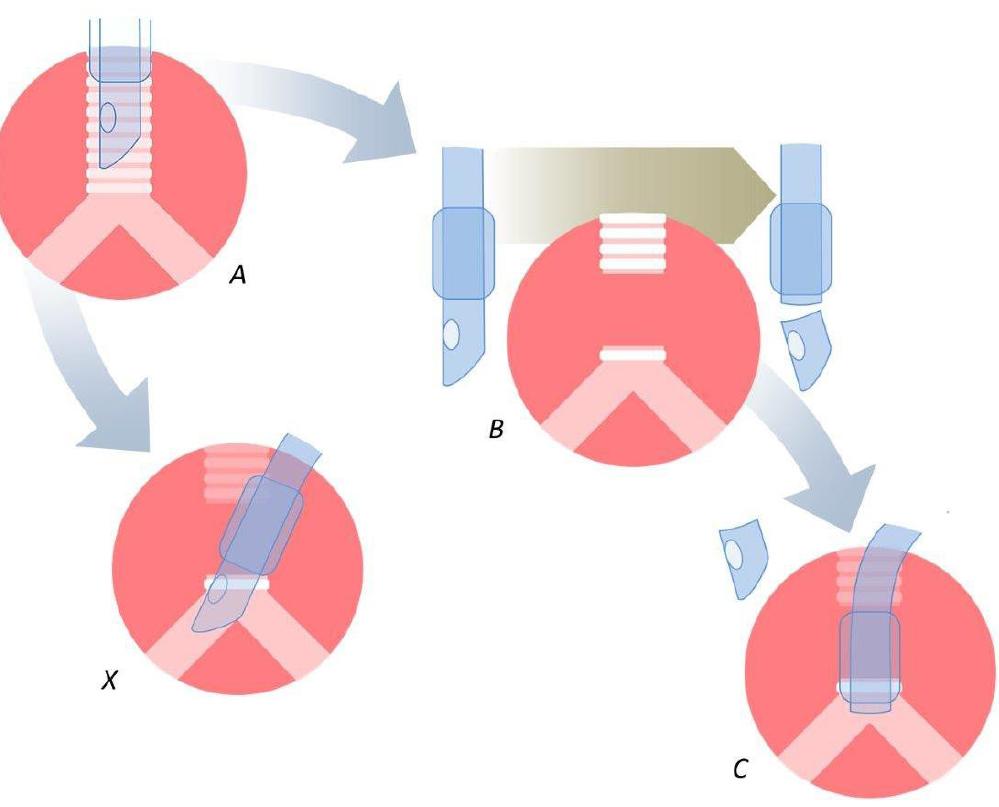 Figure 1 - Airway management for tracheal resection proximal