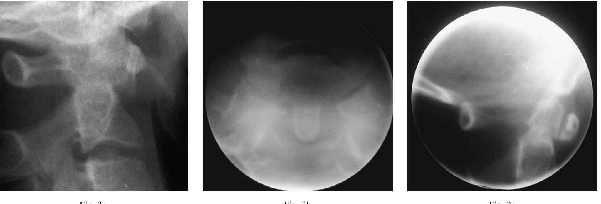 A — lateral radiograph at presentation showing anterior