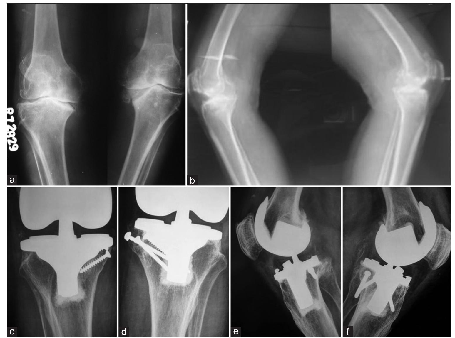 (a) standing anteroposterior radiographs of both knees with