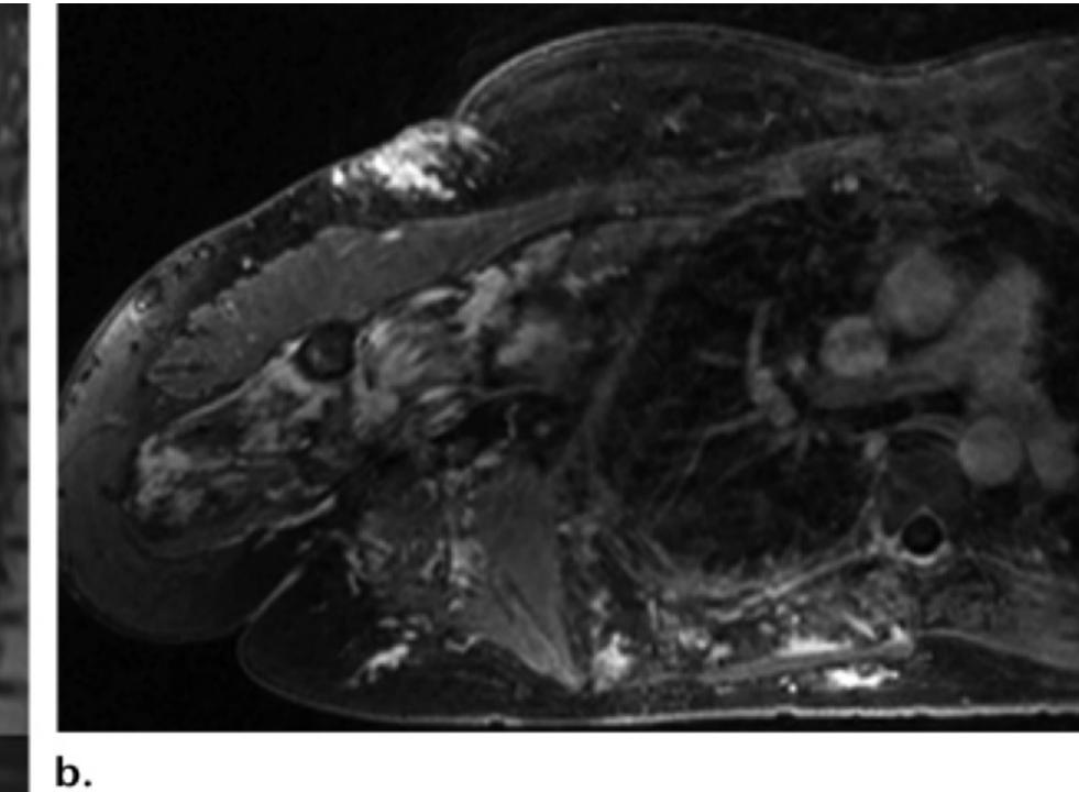 Blue rubber bleb nevus syndrome in a 32-year-old woman with