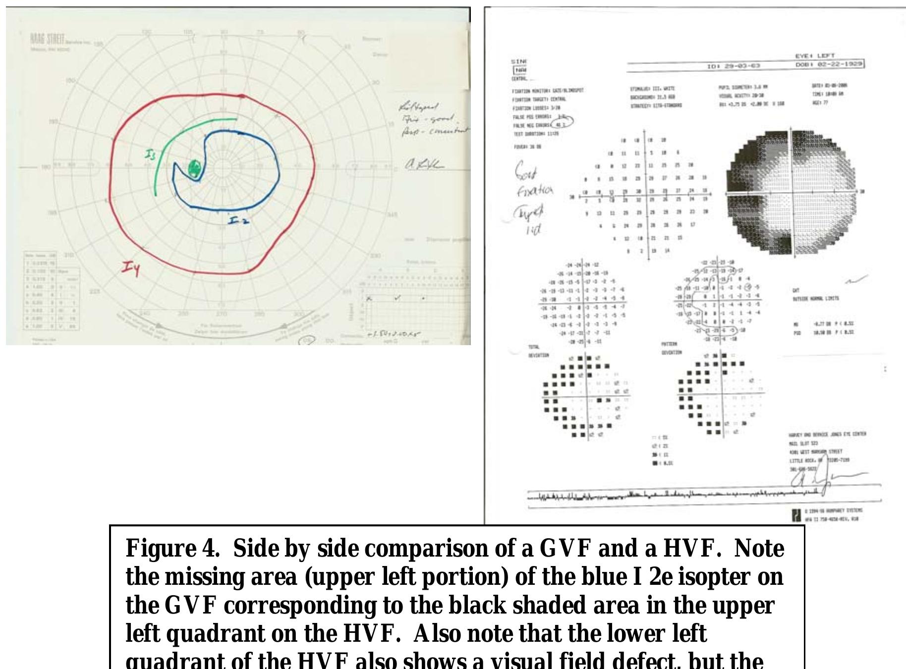 Figure 4 - Understanding Visual Fields, Part I; Goldmann