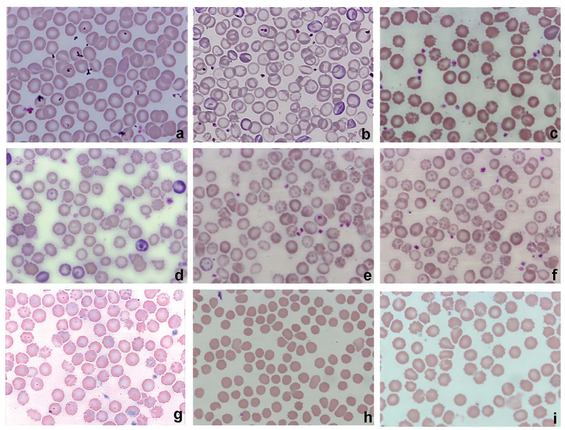 Peripheral blood smears. (a) normal control. (b) ida