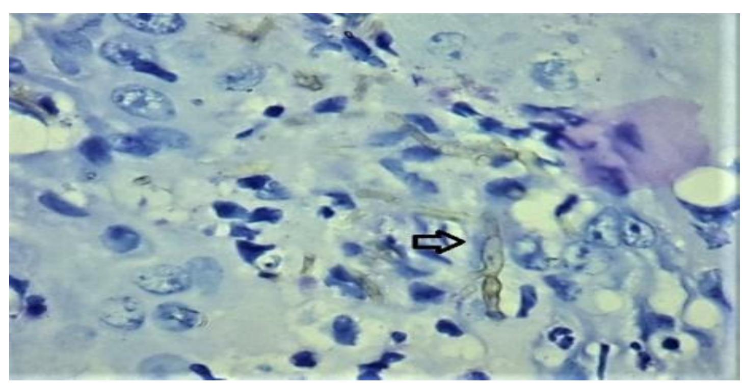 -2: biopsy from scaly plaques with verrucous nodules over