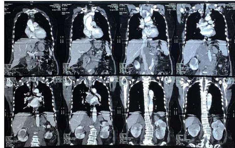 : cect abdomen and pelvis revealed multiple retroperitoneal