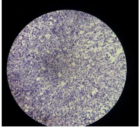 Sections from distal tibial biopsy shows necrotic and