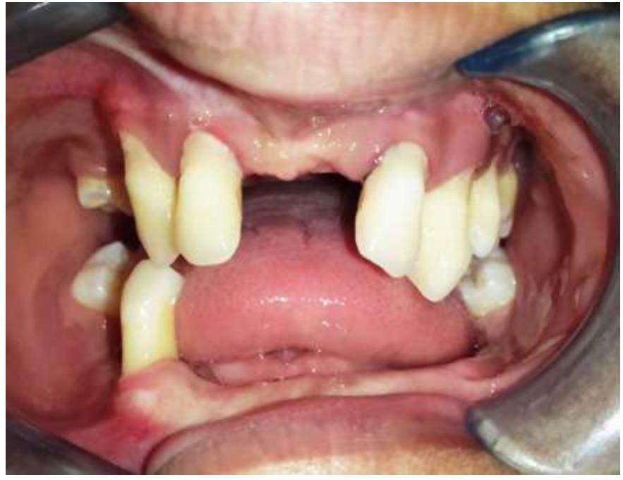 Poor periodontal status with multiple missing teeth
