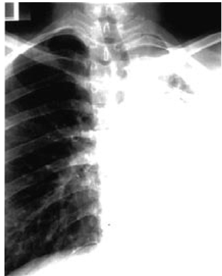 Chest radiograph shows extensive left-sided fibrosis. fig. 2