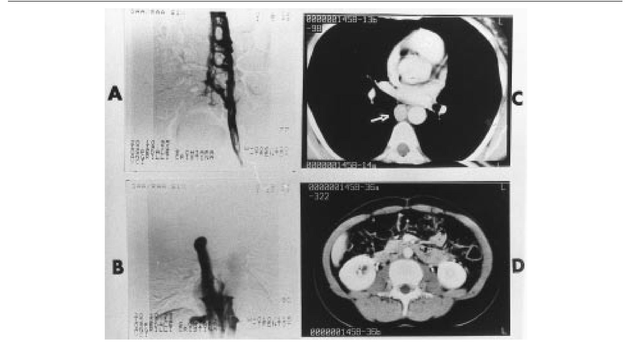 The left femoral venography shows left common iliac vein