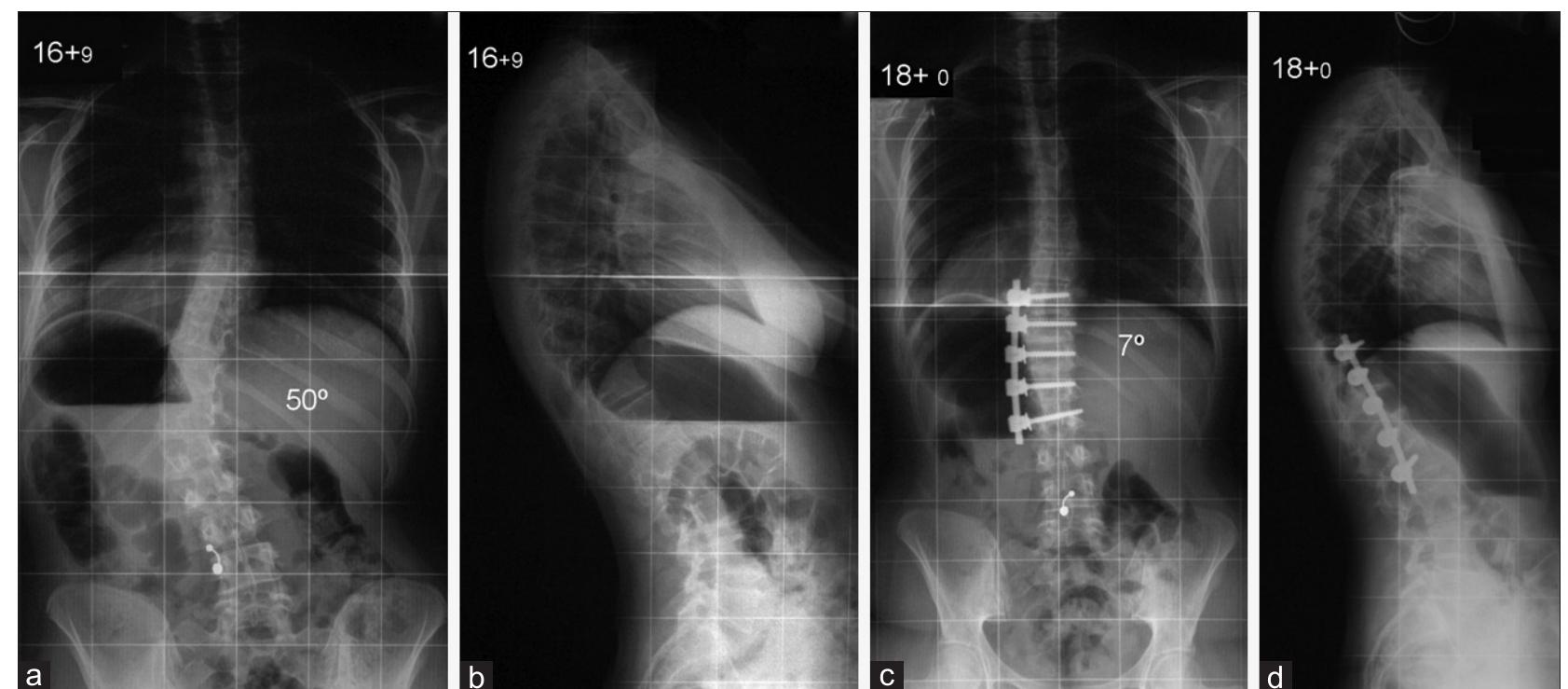Posteroanterior (a) and lateral (b) radiographs of the spine